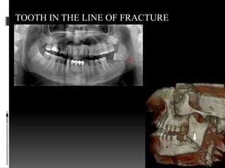 SURGICAL EXTRACTION OF MANDIBULAR THIRD MOLAR | PPTX