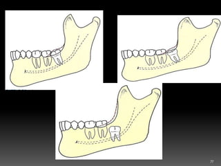 SURGICAL EXTRACTION OF MANDIBULAR THIRD MOLAR | PPTX