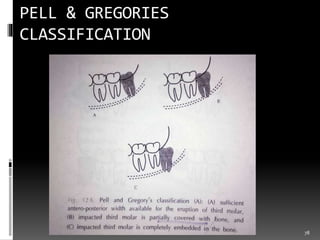 SURGICAL EXTRACTION OF MANDIBULAR THIRD MOLAR | PPTX