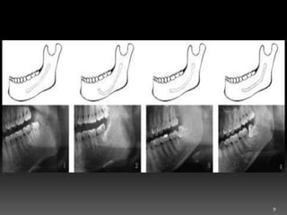 SURGICAL EXTRACTION OF MANDIBULAR THIRD MOLAR | PPTX