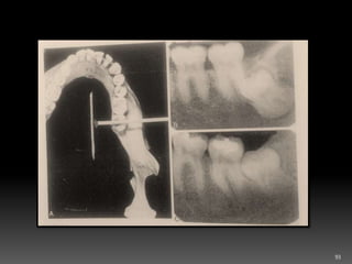 SURGICAL EXTRACTION OF MANDIBULAR THIRD MOLAR | PPTX