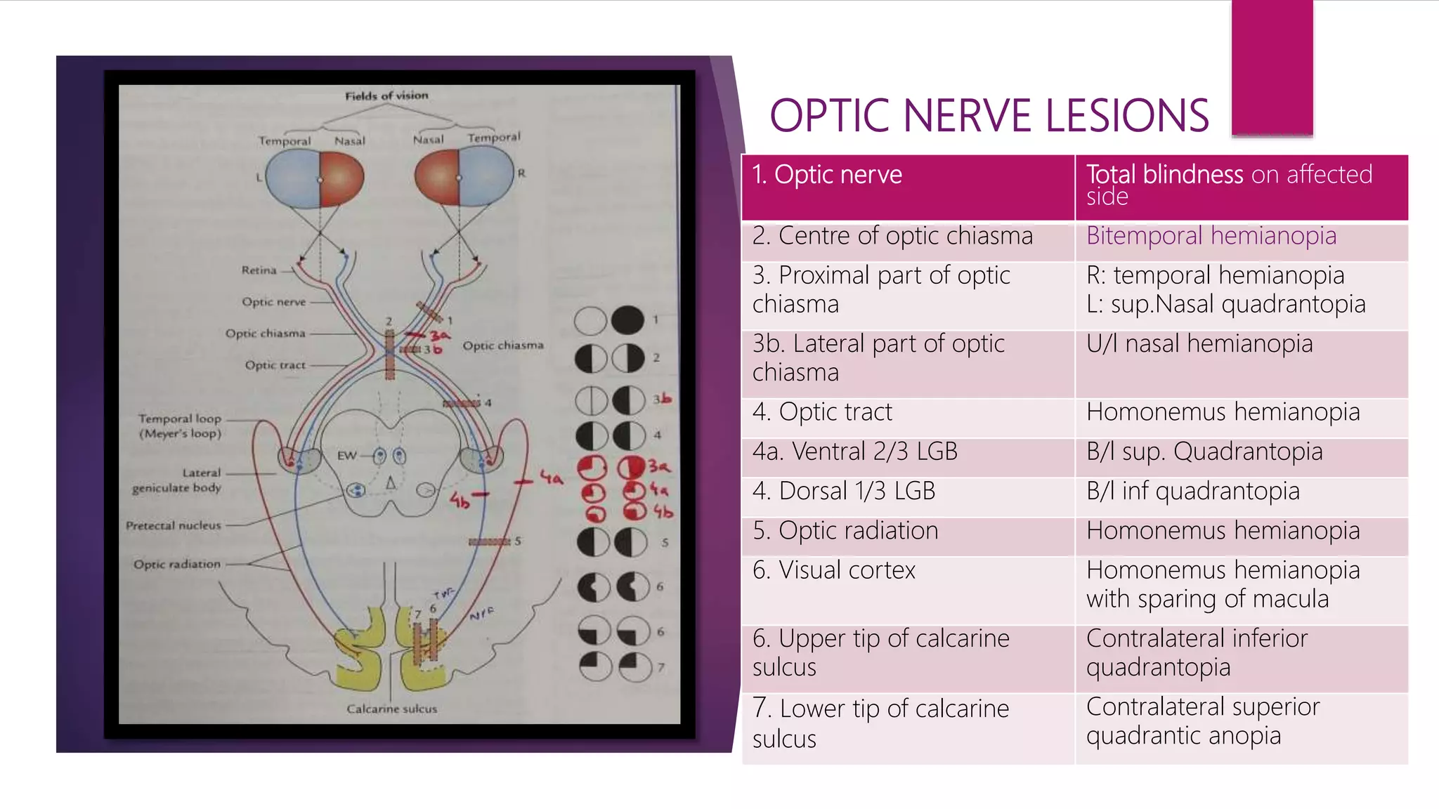 Parietal lobe it's lesions and orbital nerve pathway and it's lesions ...