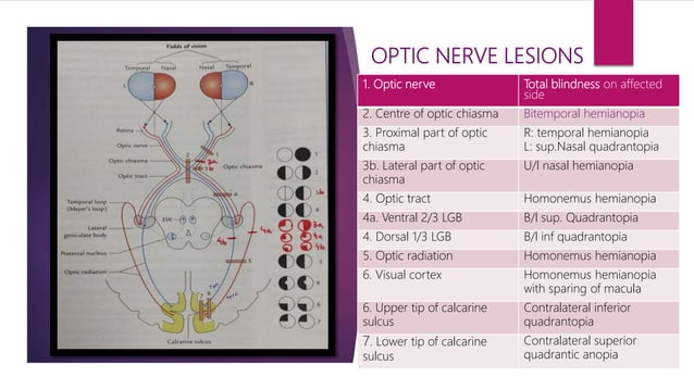 Parietal lobe it's lesions and orbital nerve pathway and it's lesions | PPT
