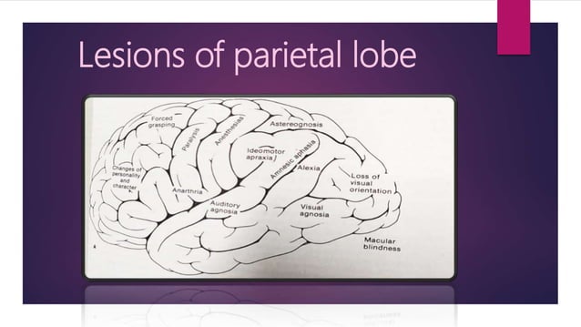 Parietal lobe it's lesions and orbital nerve pathway and it's lesions