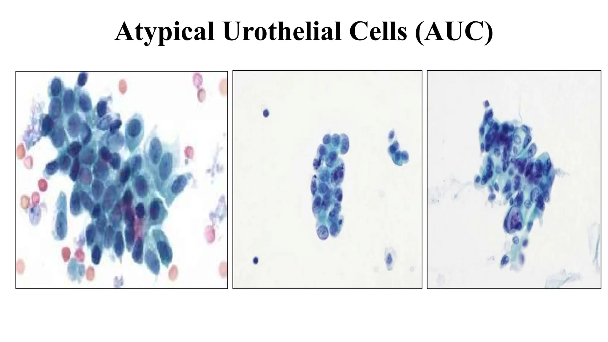 PARIS SYSTEM FOR URINE CYTOLOGY paris system of reporting urine ...