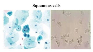PARIS SYSTEM FOR URINE CYTOLOGY paris system of reporting urine ...