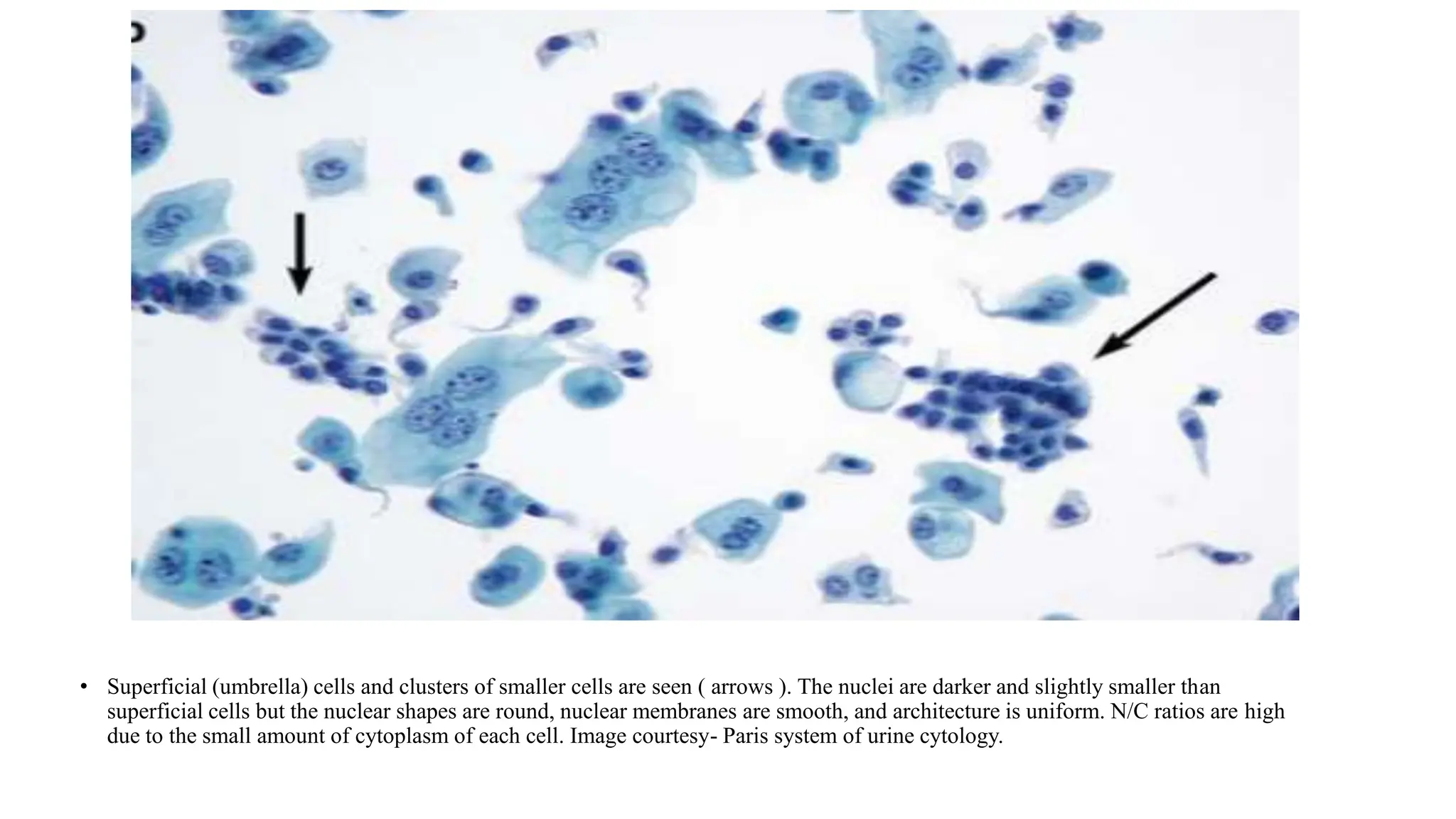 paris system of urine (cytology)Dr.Ankita Singh | PPTX
