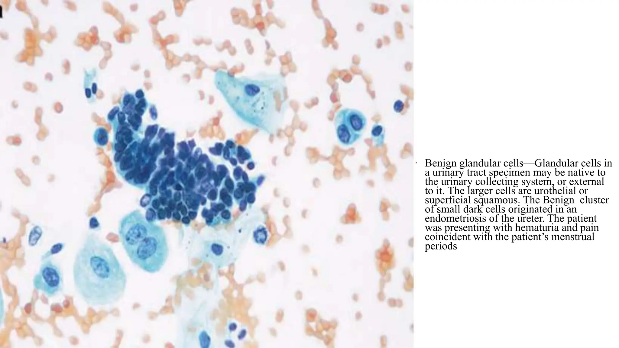 paris system of urine (cytology)Dr.Ankita Singh | PPTX