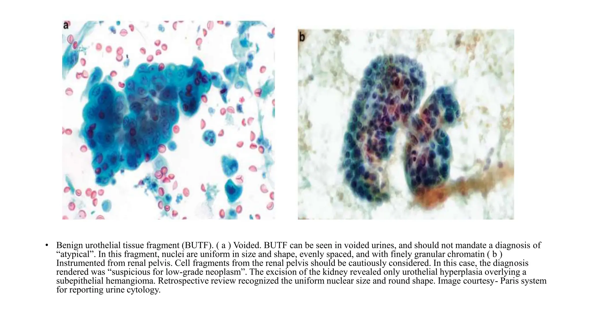 paris system of urine (cytology)Dr.Ankita Singh | PPTX