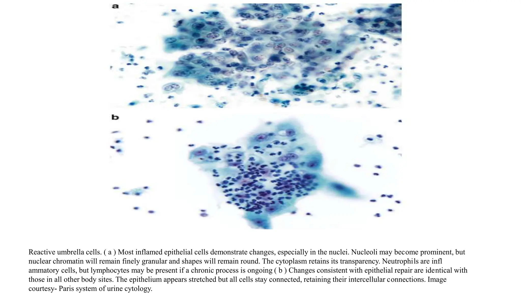 paris system of urine (cytology)Dr.Ankita Singh | PPTX