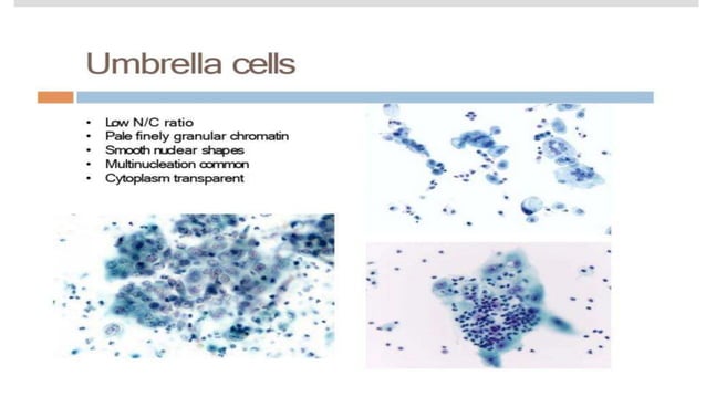 paris system of urine (cytology)Dr.Ankita Singh | PPTX