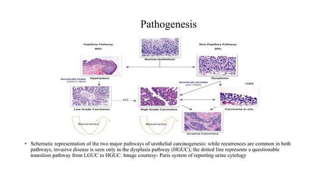 paris system of urine (cytology)Dr.Ankita Singh | PPTX