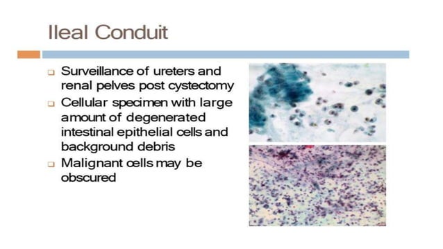 paris system of urine (cytology)Dr.Ankita Singh | PPTX