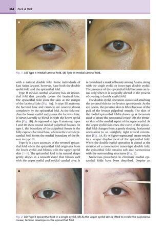 Park Z-Epicanthoplasty | PDF