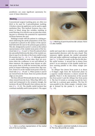 Park Z-Epicanthoplasty | PDF