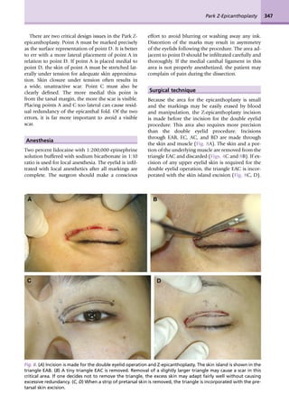 Park Z-Epicanthoplasty | PDF