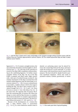 Park Z-Epicanthoplasty | PDF