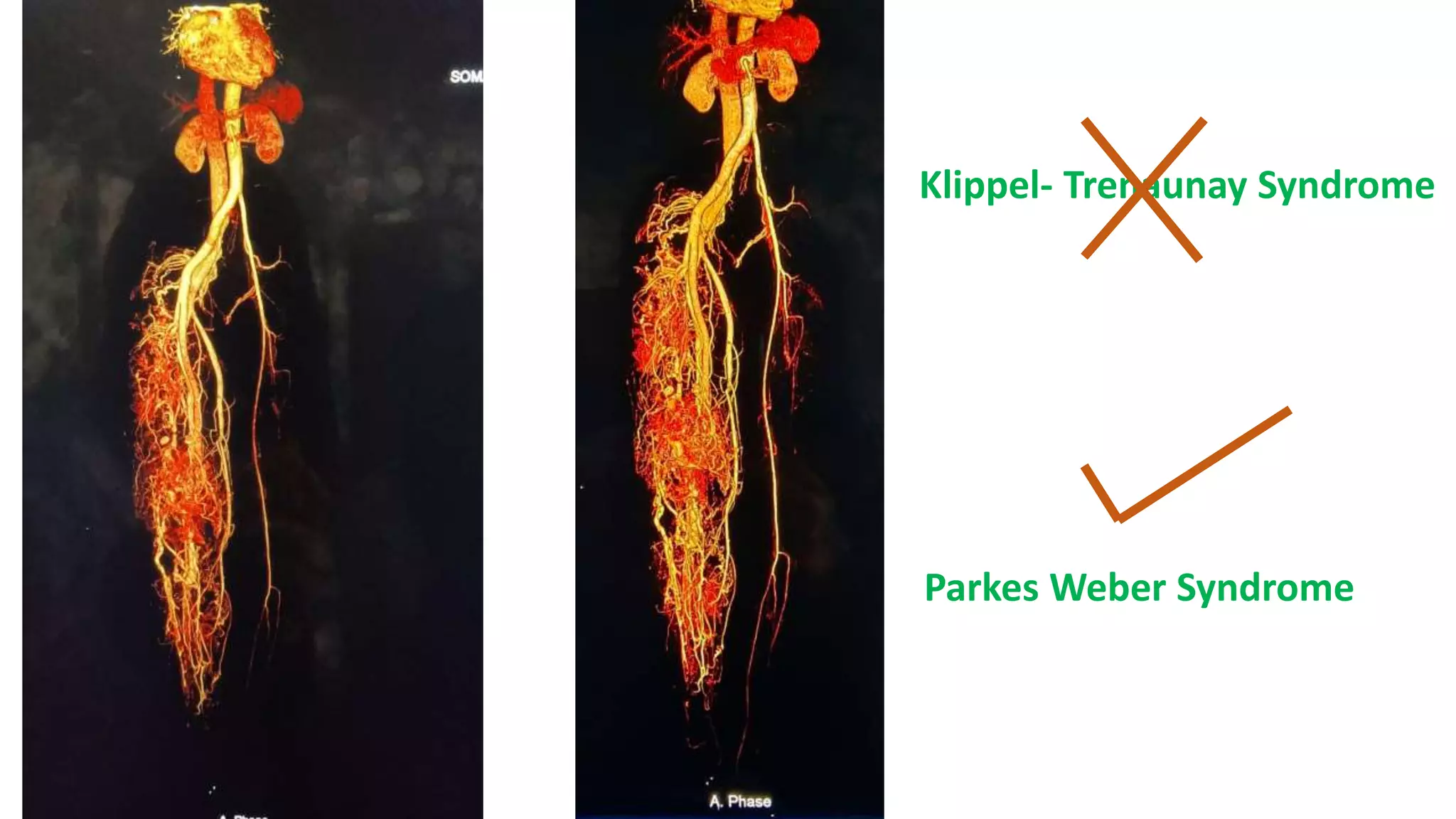 Parkes Weber syndrome.pptx