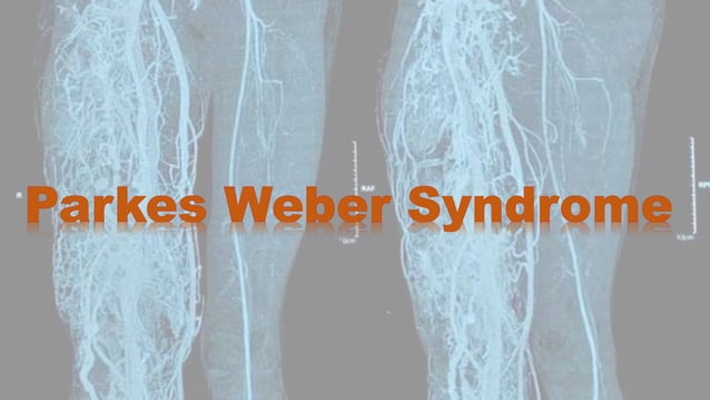 Parkes Weber syndrome.pptx