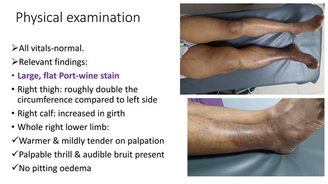 Parkes Weber syndrome.pptx