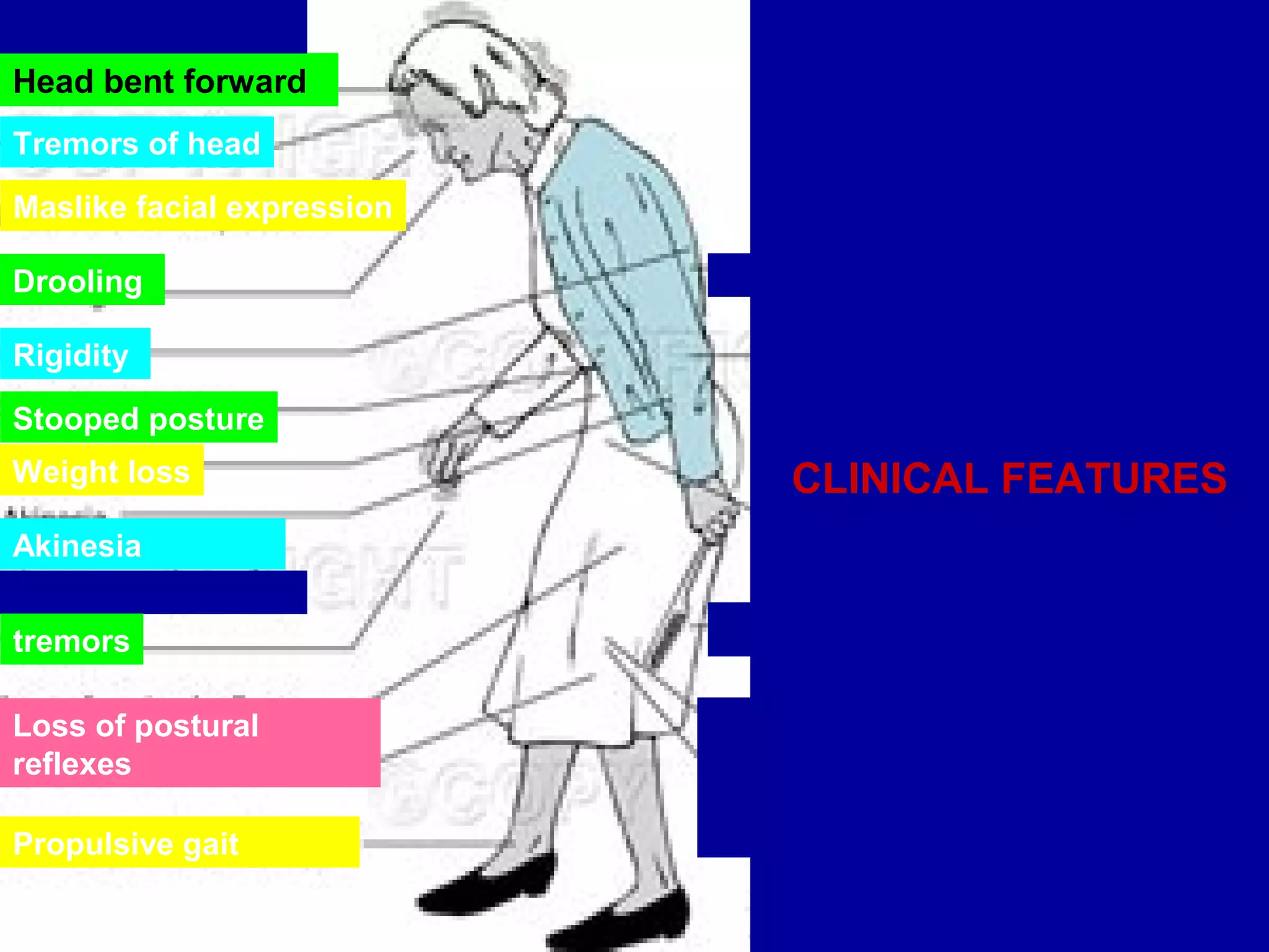 Parkinsonism | PPT