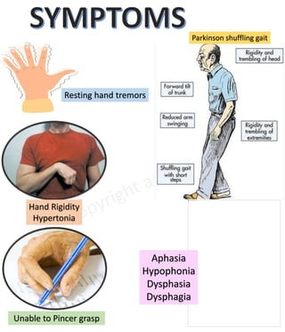 parkinson | PPTX