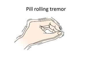 Pill Rolling Tremor