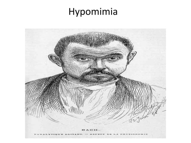 Hypokinetic Movement Disorders - Parkinson disease | PPT