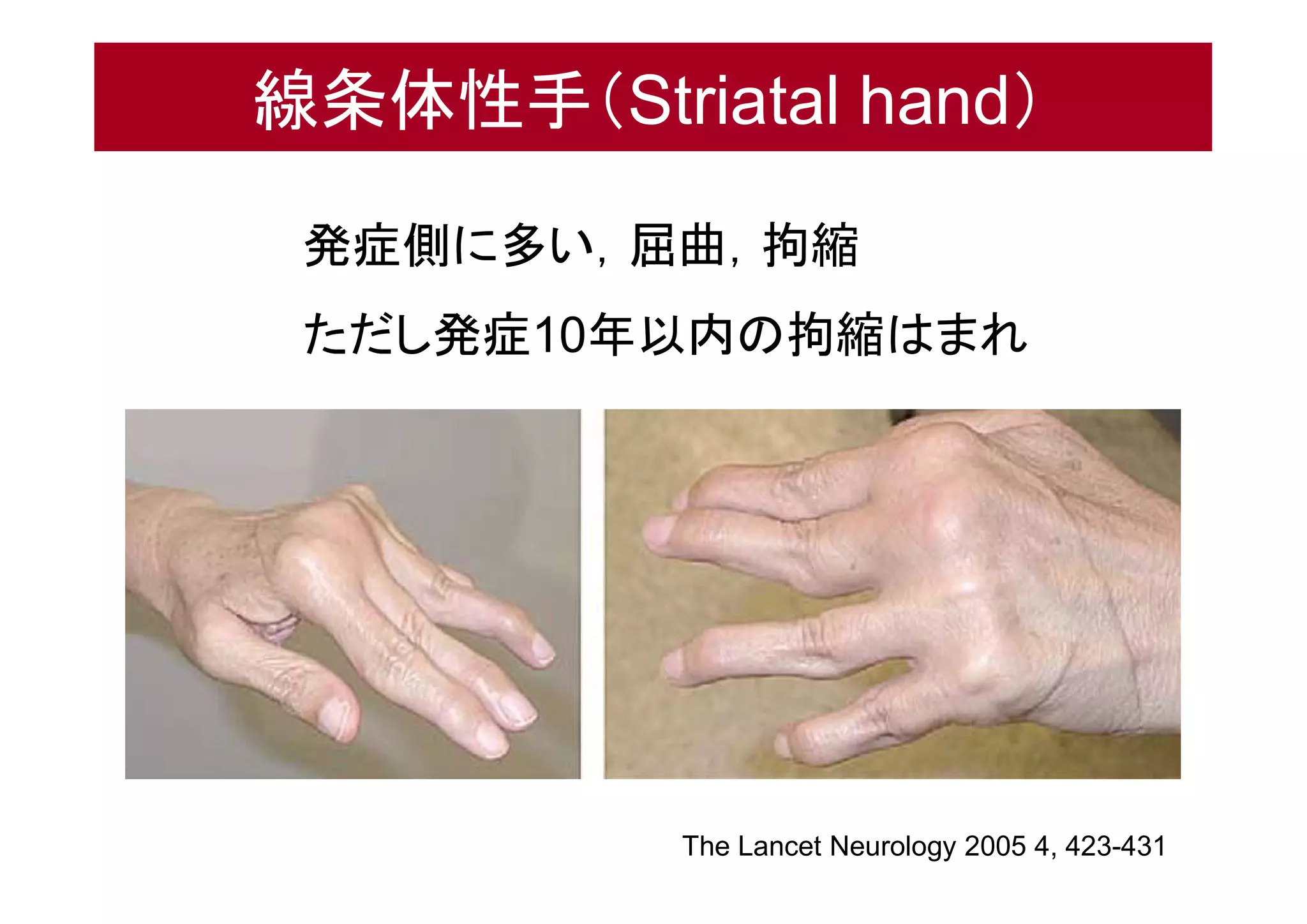 Parkinson disease pain and surgery | PDF