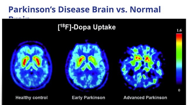 PARKINSON ML using machine learning and SVM | PPTX