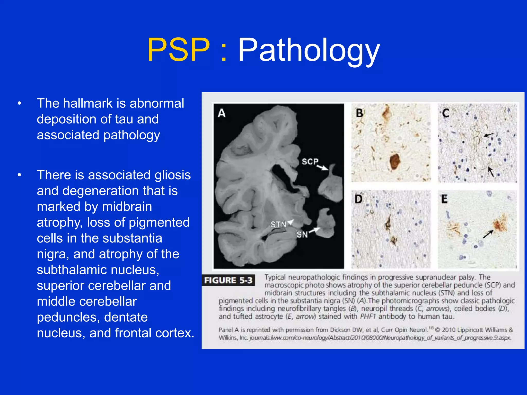 Parkinson plus syndrome | PPT
