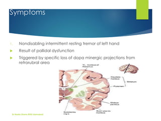 Parkinson's Disease - Neurology | PDF