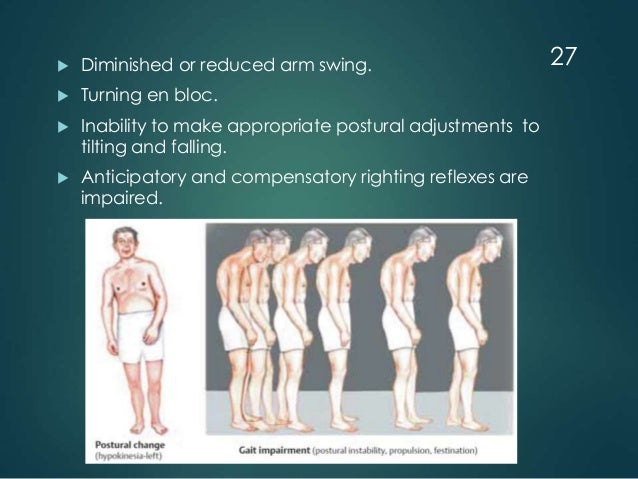 Parkinson’s disease