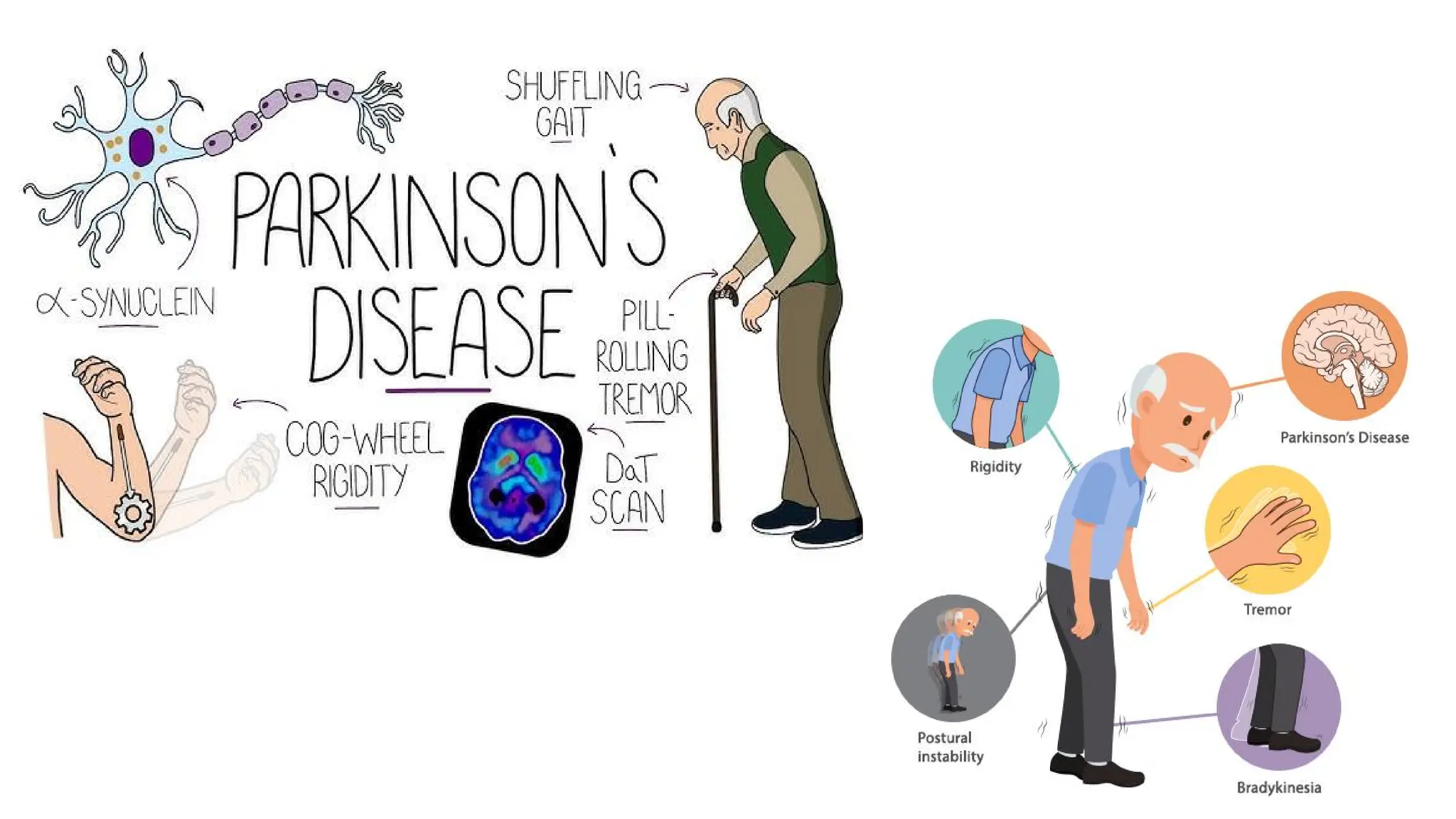 PARKINSON'S DISEASE And pathophysiology .pdf by SMH.pdf
