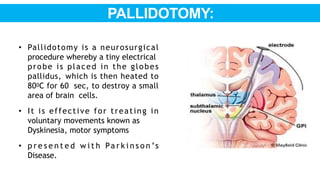 PARKINSON'S DISEASE And pathophysiology .pdf by SMH.pdf