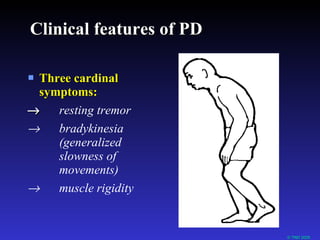 Parkinson's disease an overview | PPT