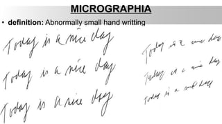 parkinson's disease (updated).pptx