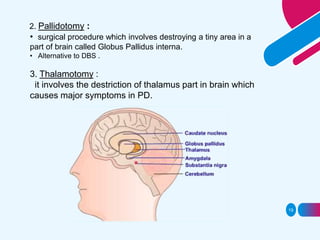 PARKINSON’S DISEASE | PPTX