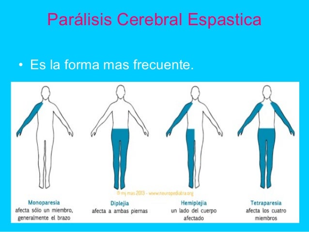 Parálisis cerebral