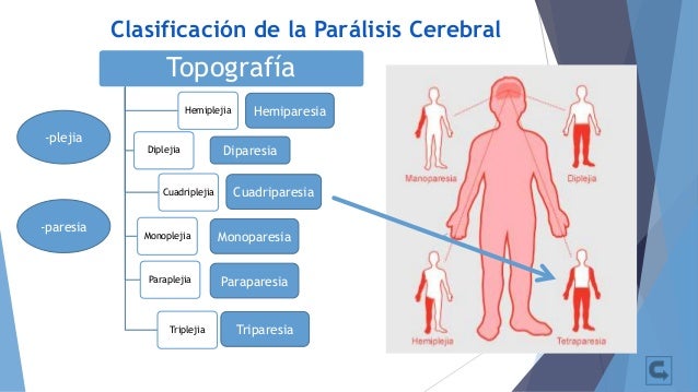 Parálisis cerebral
