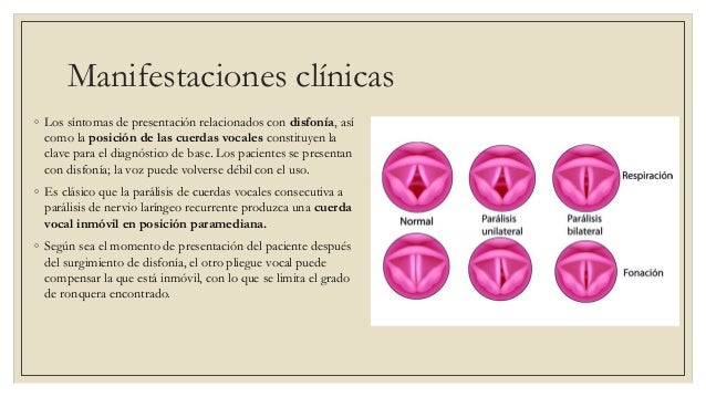 Parálisis de las cuerdas vocales