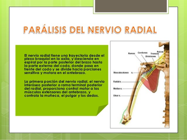 Parálisis del nervio radial