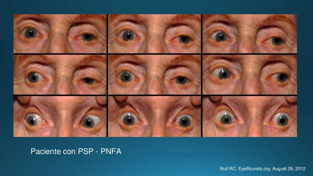Parálisis supranuclear progresiva..pptx.pptx