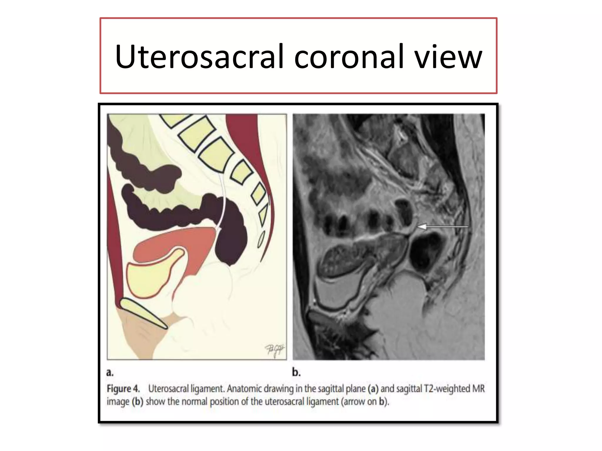 TARGET DELINEATION OF PARAMETRIUM | PPTX