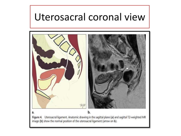 TARGET DELINEATION OF PARAMETRIUM | PPTX