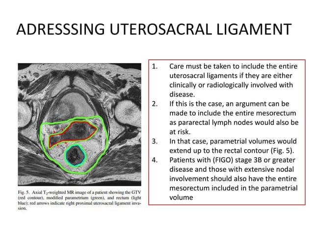 TARGET DELINEATION OF PARAMETRIUM | PPTX