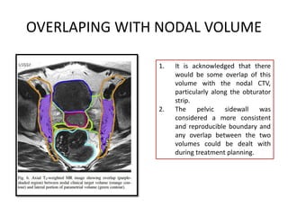 TARGET DELINEATION OF PARAMETRIUM | PPTX