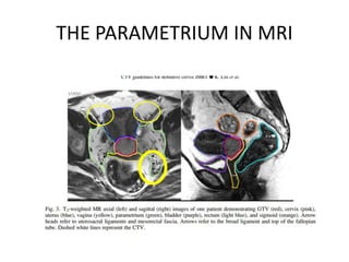 TARGET DELINEATION OF PARAMETRIUM | PPTX