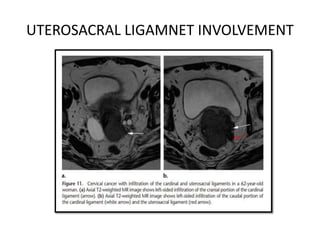 Parametrium Radiology