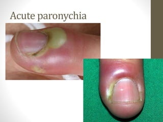 Paronychia | PPTX